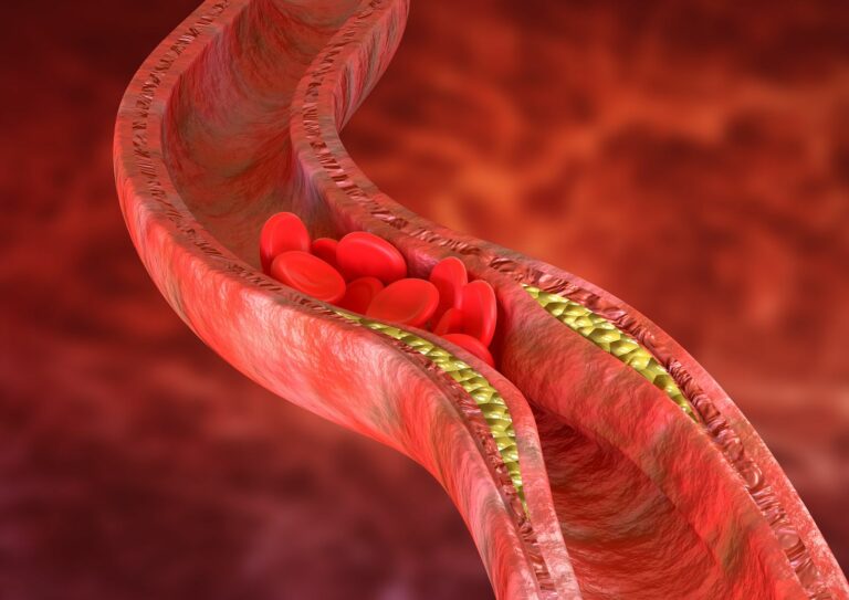 Arterioesclerosis: Qué es, síntomas y causas - Primicias 24