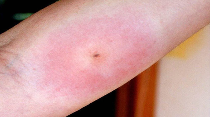 Sugieren mantener la higiene para prevenir enfermedades transmitidas ...