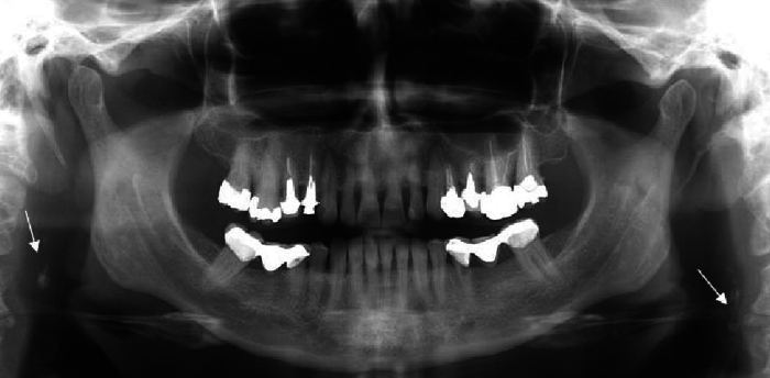 ¿Sabes qué son las calcificaciones? - Primicias 24