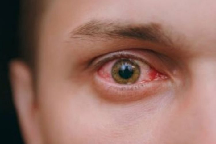 Conoce las causas y tratamientos del ‘ojo rojo’ - Primicias 24
